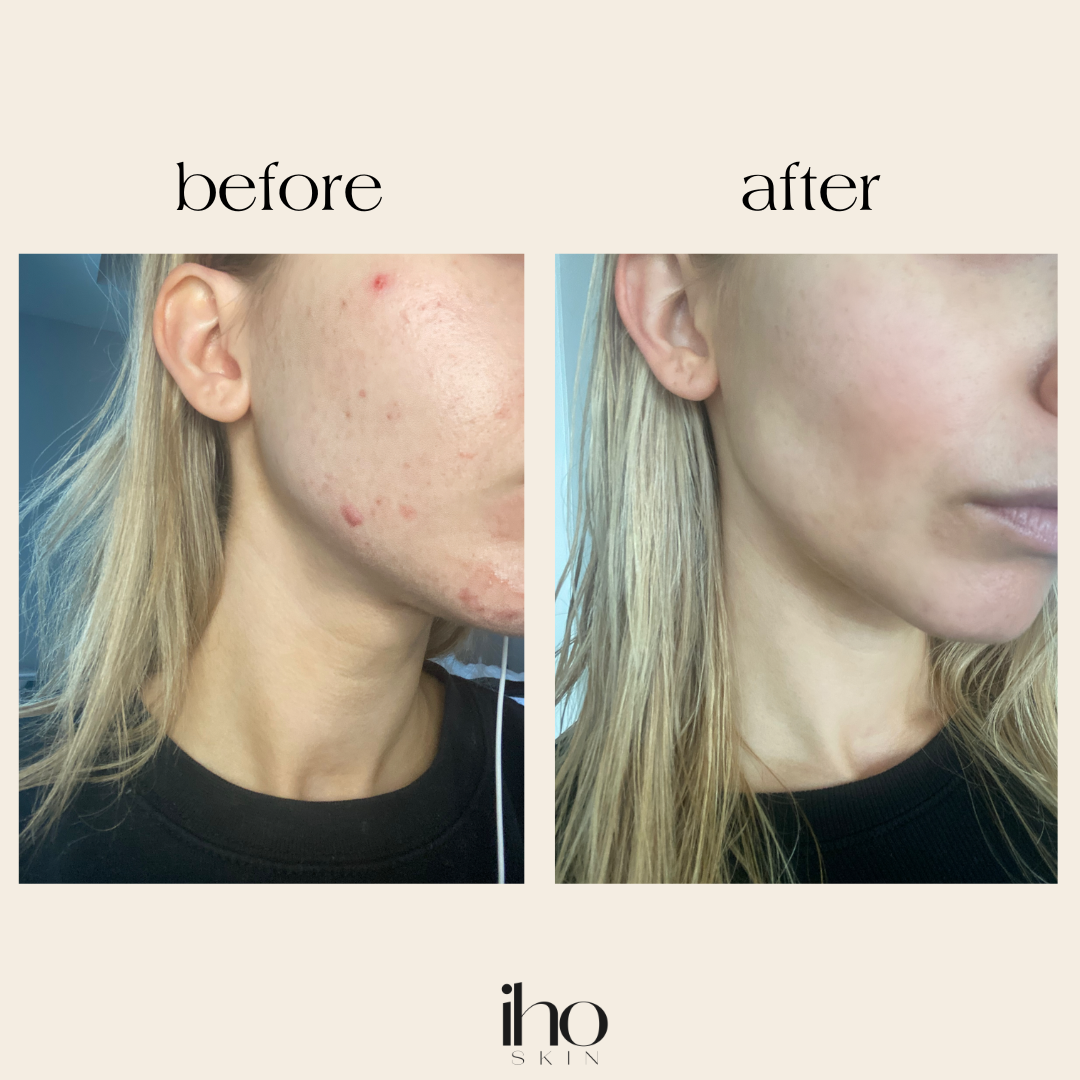 Dry Skin and Acne: Finding the Right Balance – Iho Skin